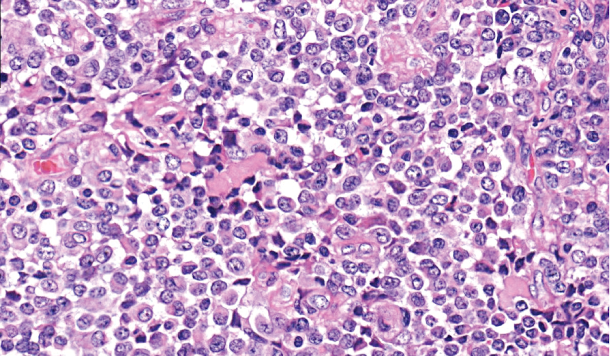 Atypical Teratoid/Rhabdoid Tumor | Children's Brain Tumor Network