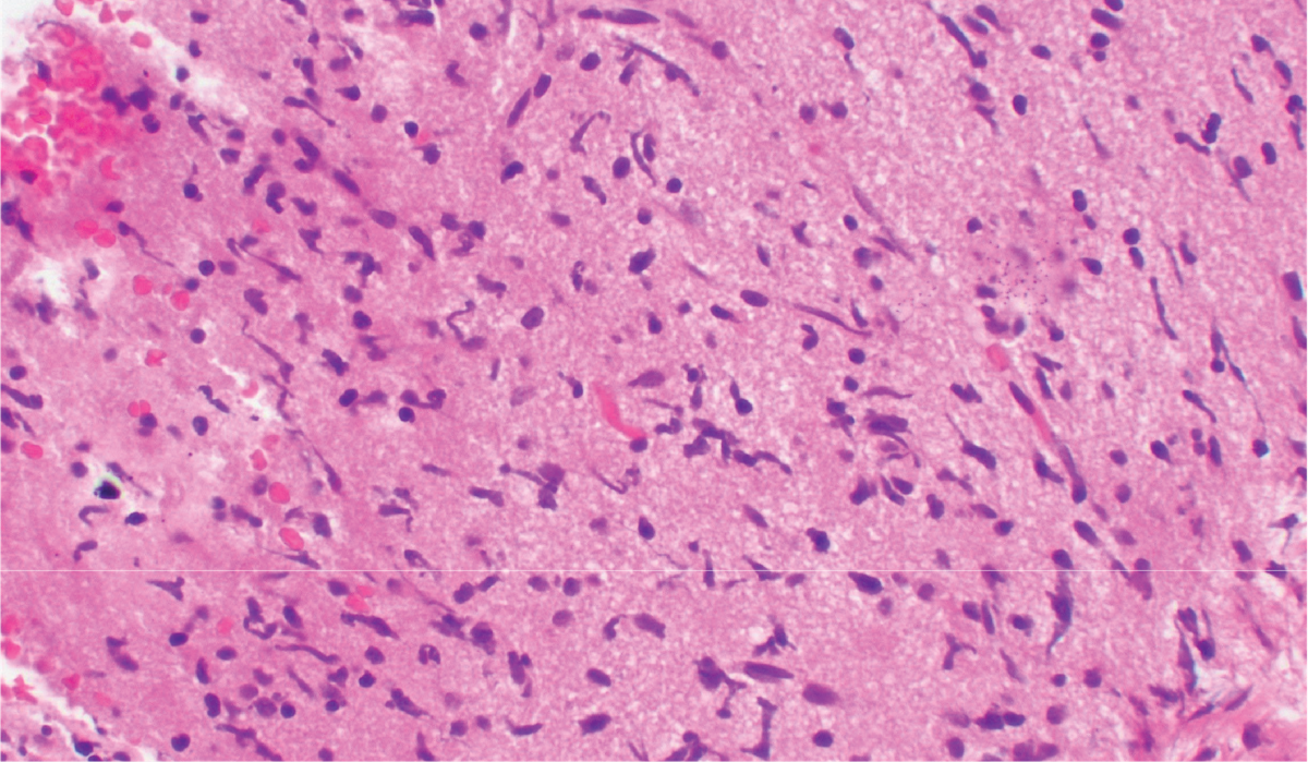Diffuse Intrinsic Pontine Glioma | Children's Brain Tumor Network