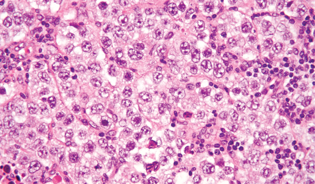 Germinoma | Children's Brain Tumor Network