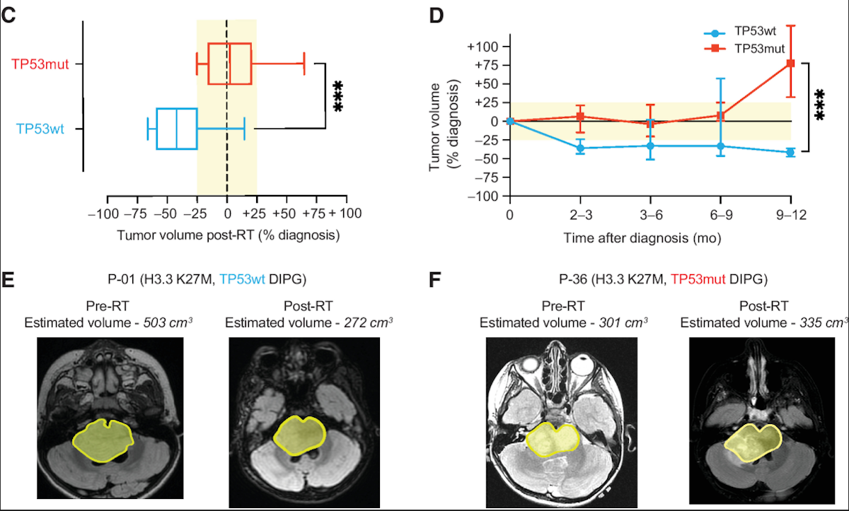 Upfront Biology-Guided Therapy in Diffuse Intrinsic Pontine Glioma: Therapeutic, Molecular, and ...
